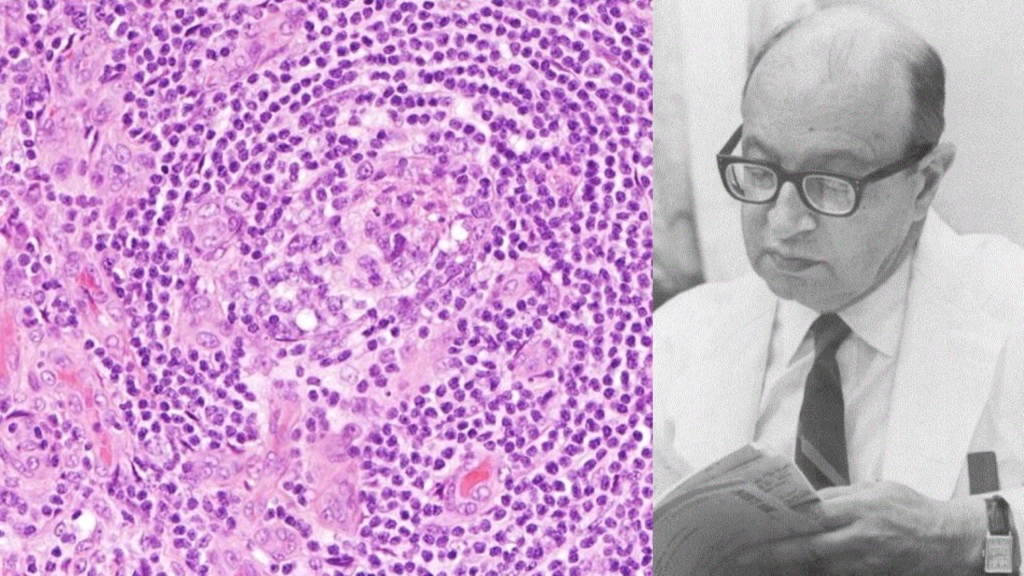 Castleman – Site de référence sur la maladie de Castleman